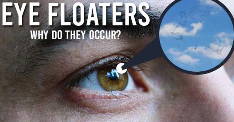Arizona Eye Center - Floaters